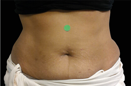 BTL Cellutone Treatment for Cellulite Reduction | Biologi Spa