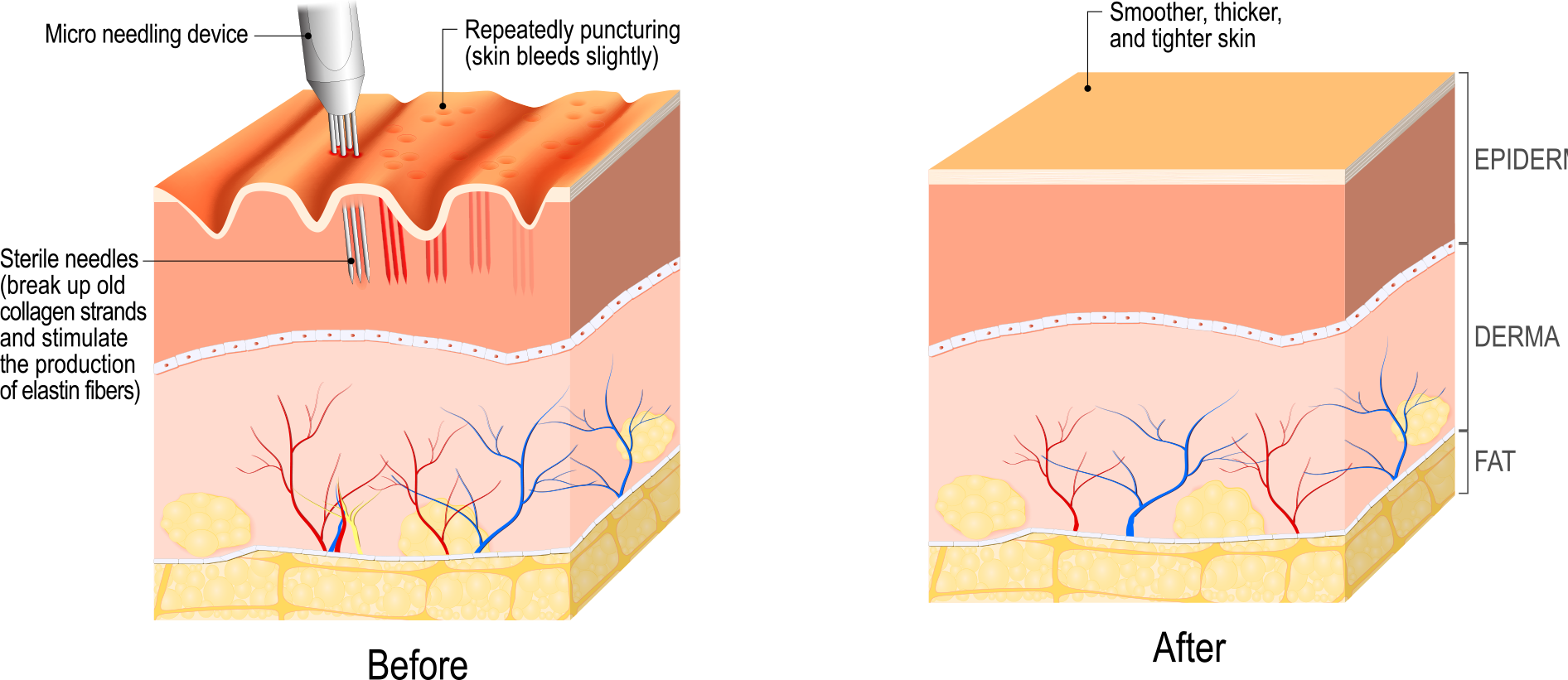 Microneedling Treatment Newport Beach | Biologi MD