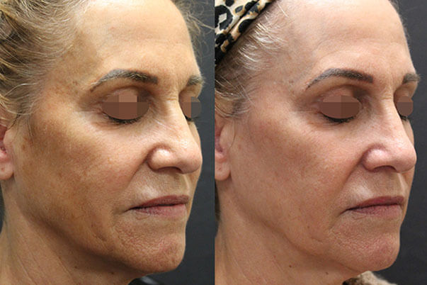 BEFORE & AFTER